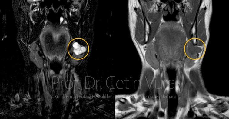 Salivary Gland Tumors - Head and Neck Surgery Istanbul