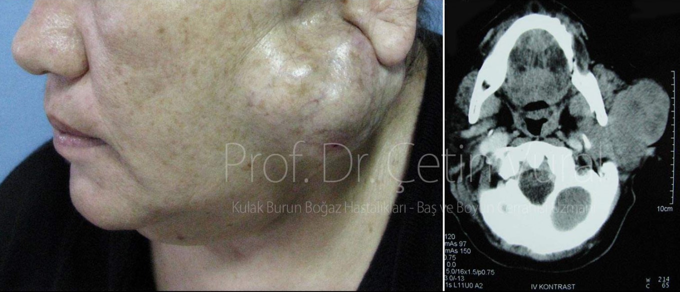 Salivary Gland Tumors - Head and Neck Surgery Istanbul